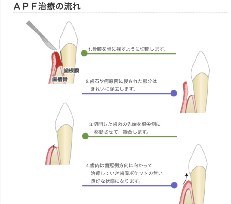 クラウンレングスニングとAPF(Apically Positioned Flap)② - 医療法人社団徹心会ハートフル歯科